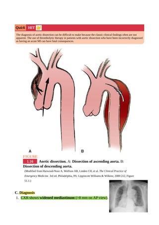 Aortic Dissection (cardiovascular system) | PDF