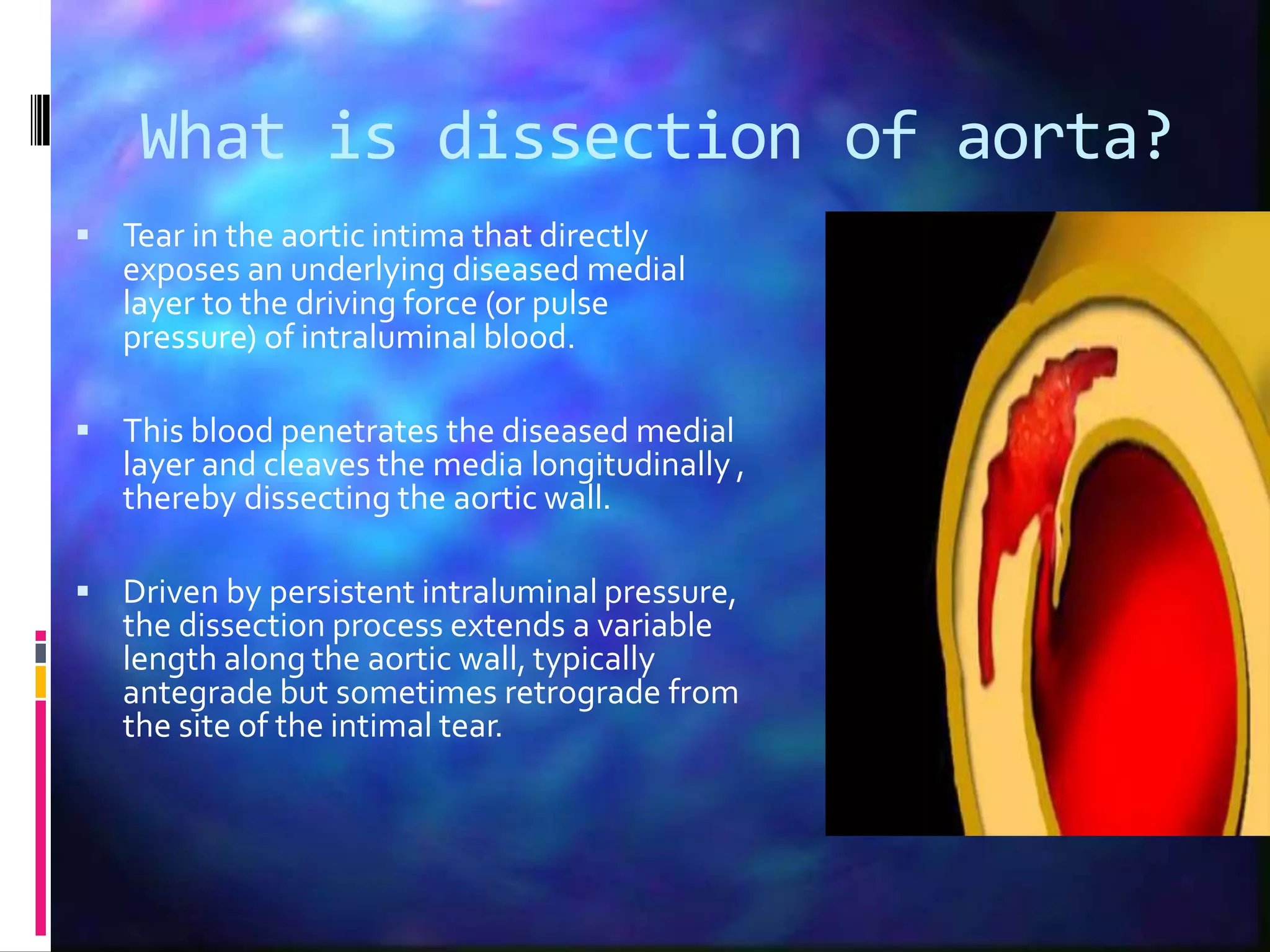 Aortic dissection dr.tapu