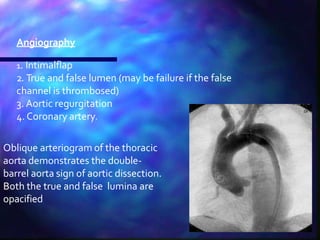 Aortic dissection dr.tapu