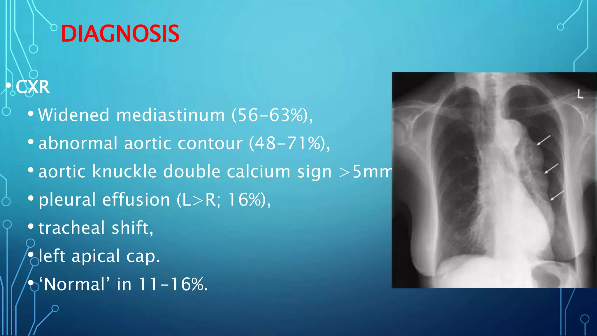 Aortic dissection time is ticking! | PPTX