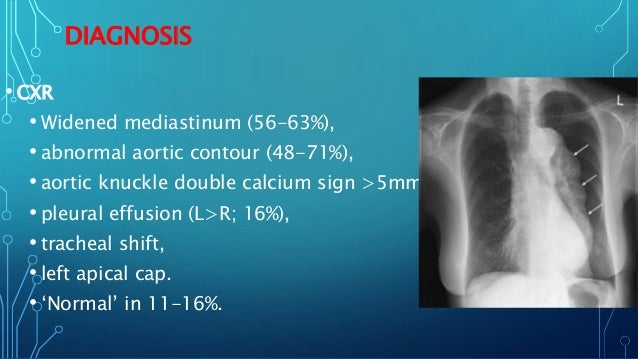 Aortic dissection time is ticking!