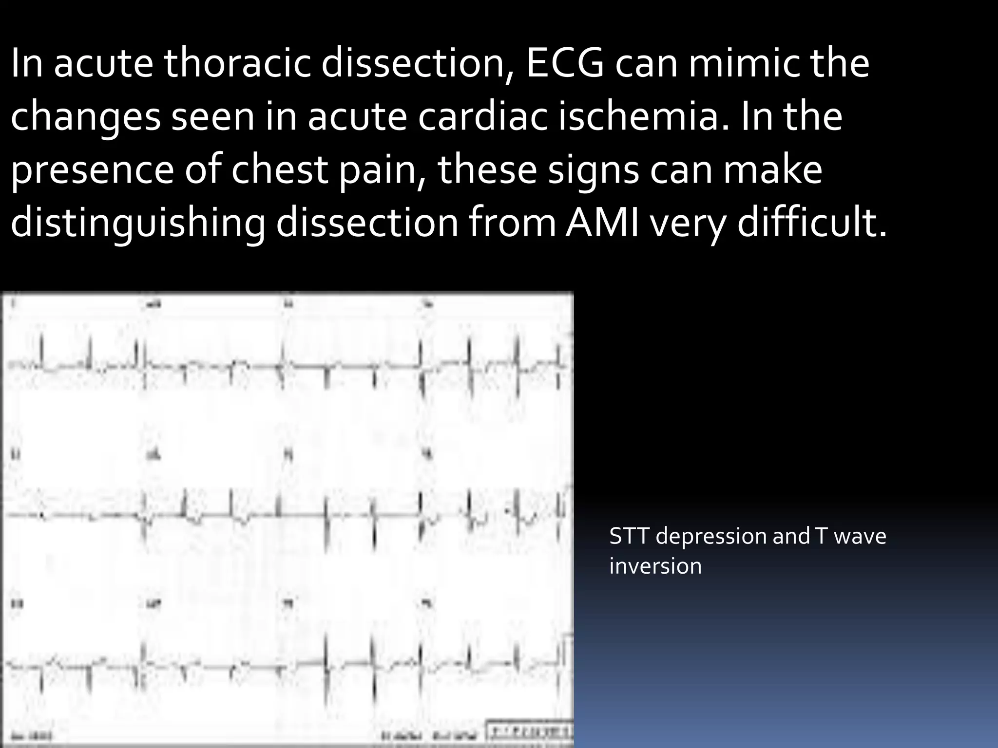 Aortic dissection 01 | PPTX