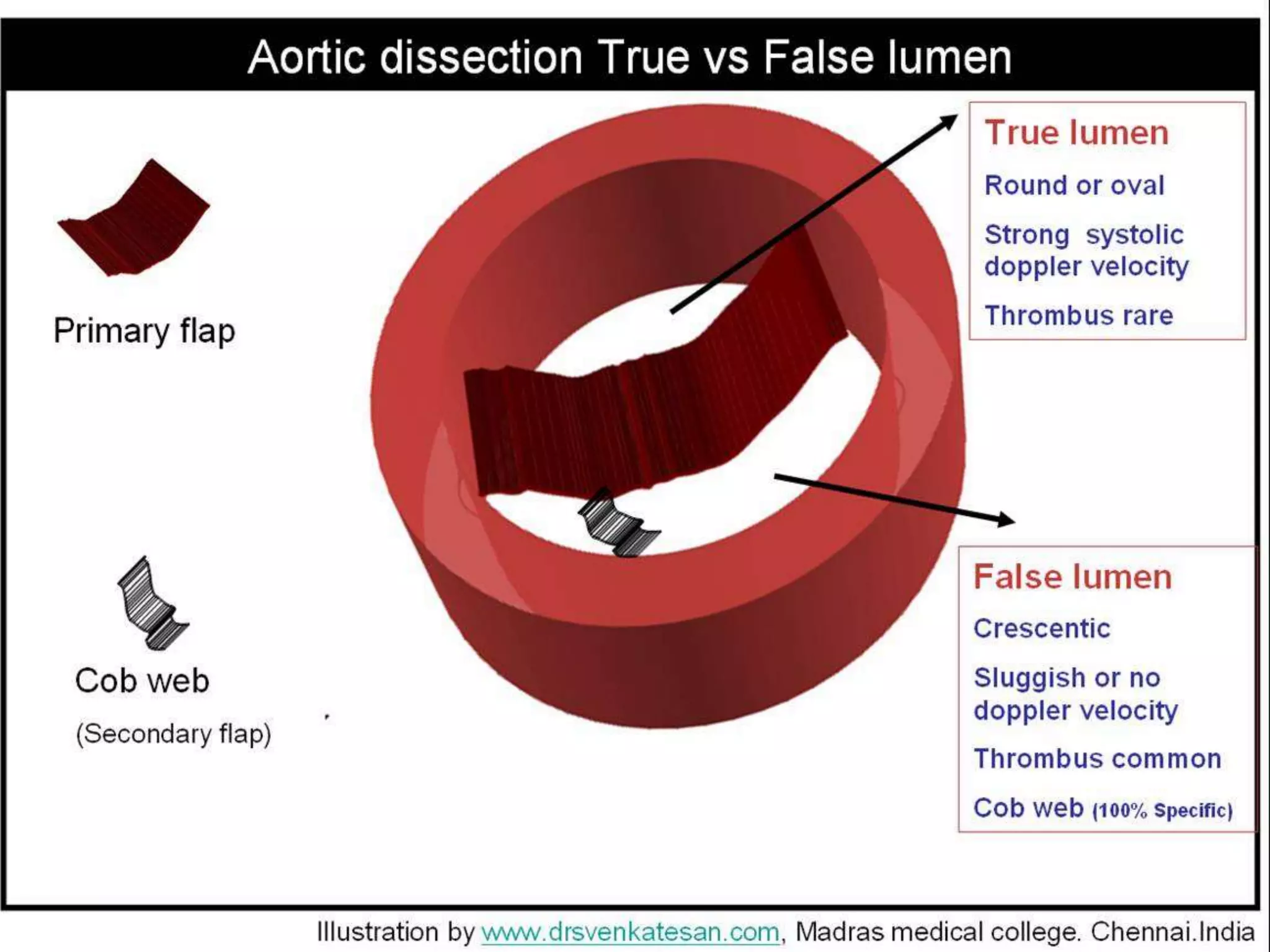 Aortic dissection 01 | PPTX