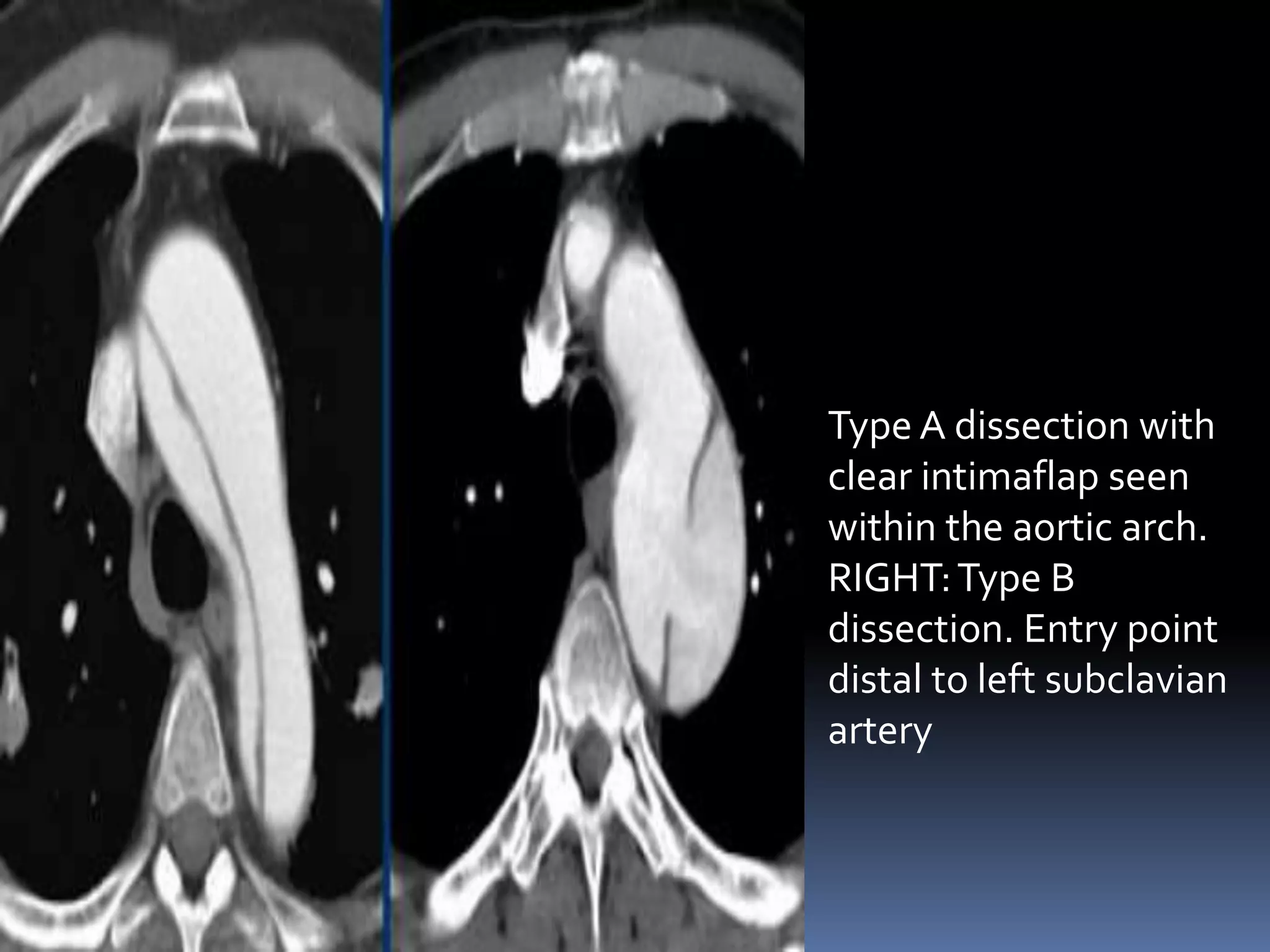 Aortic dissection 01 | PPTX