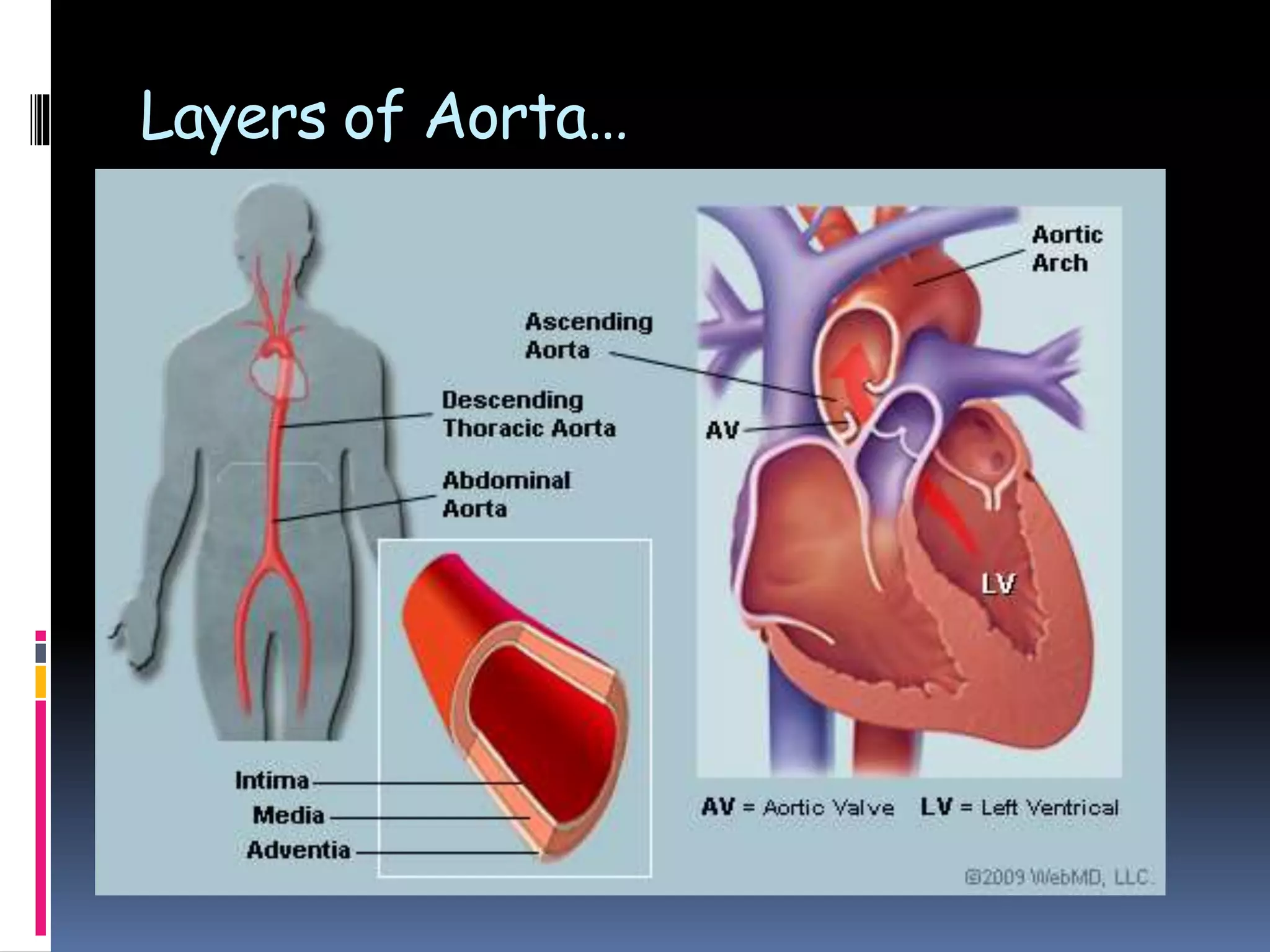 Aortic dissection 01 | PPTX
