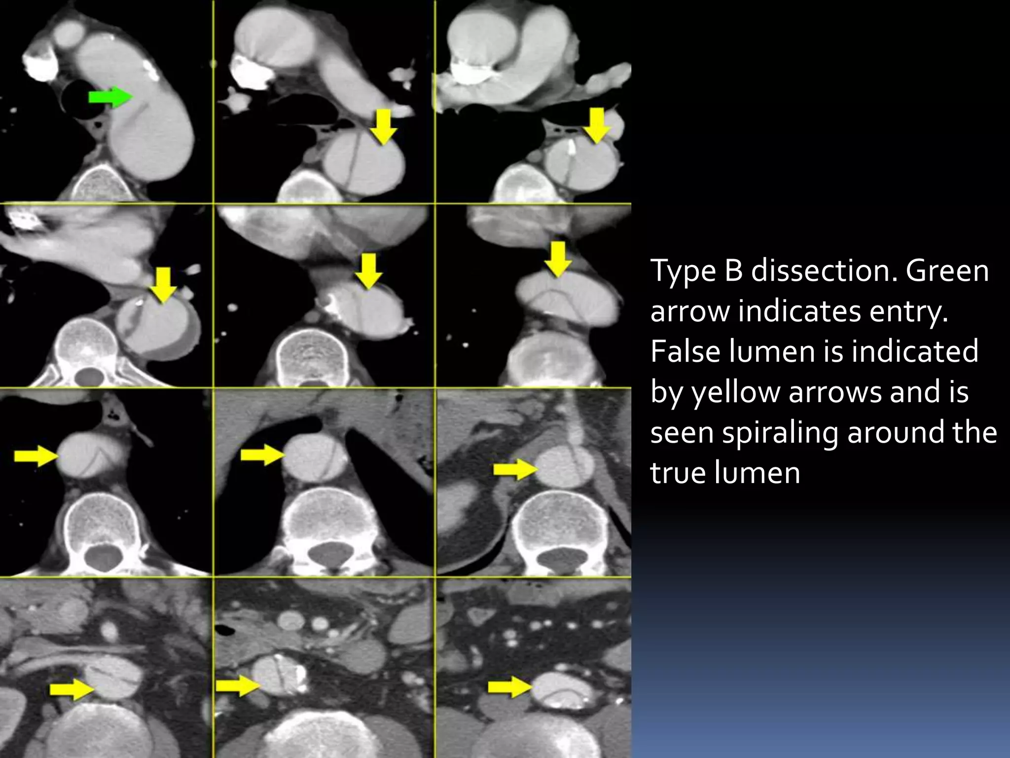 Aortic dissection 01 | PPTX