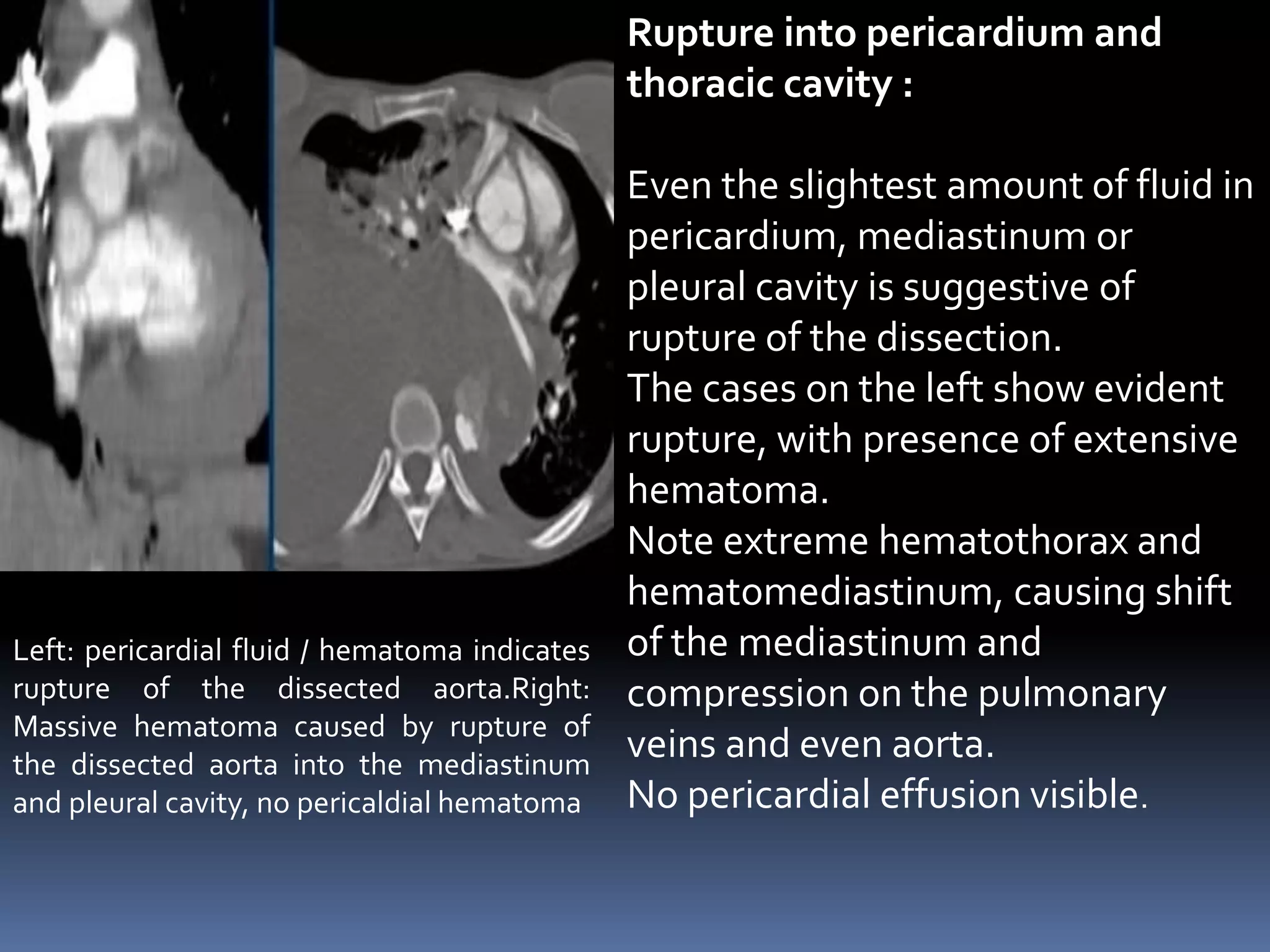 Aortic dissection 01 | PPTX