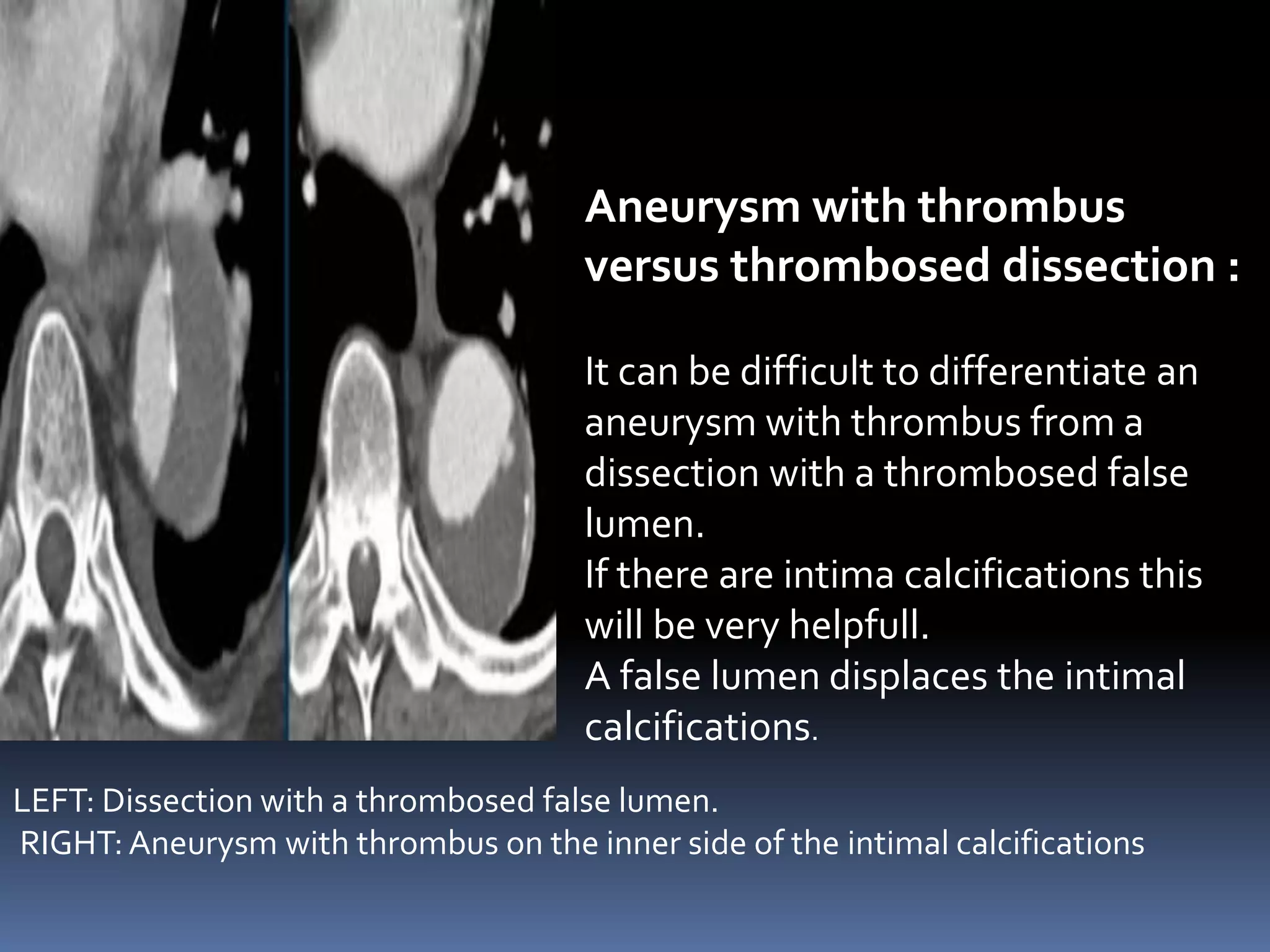 Aortic dissection 01 | PPTX