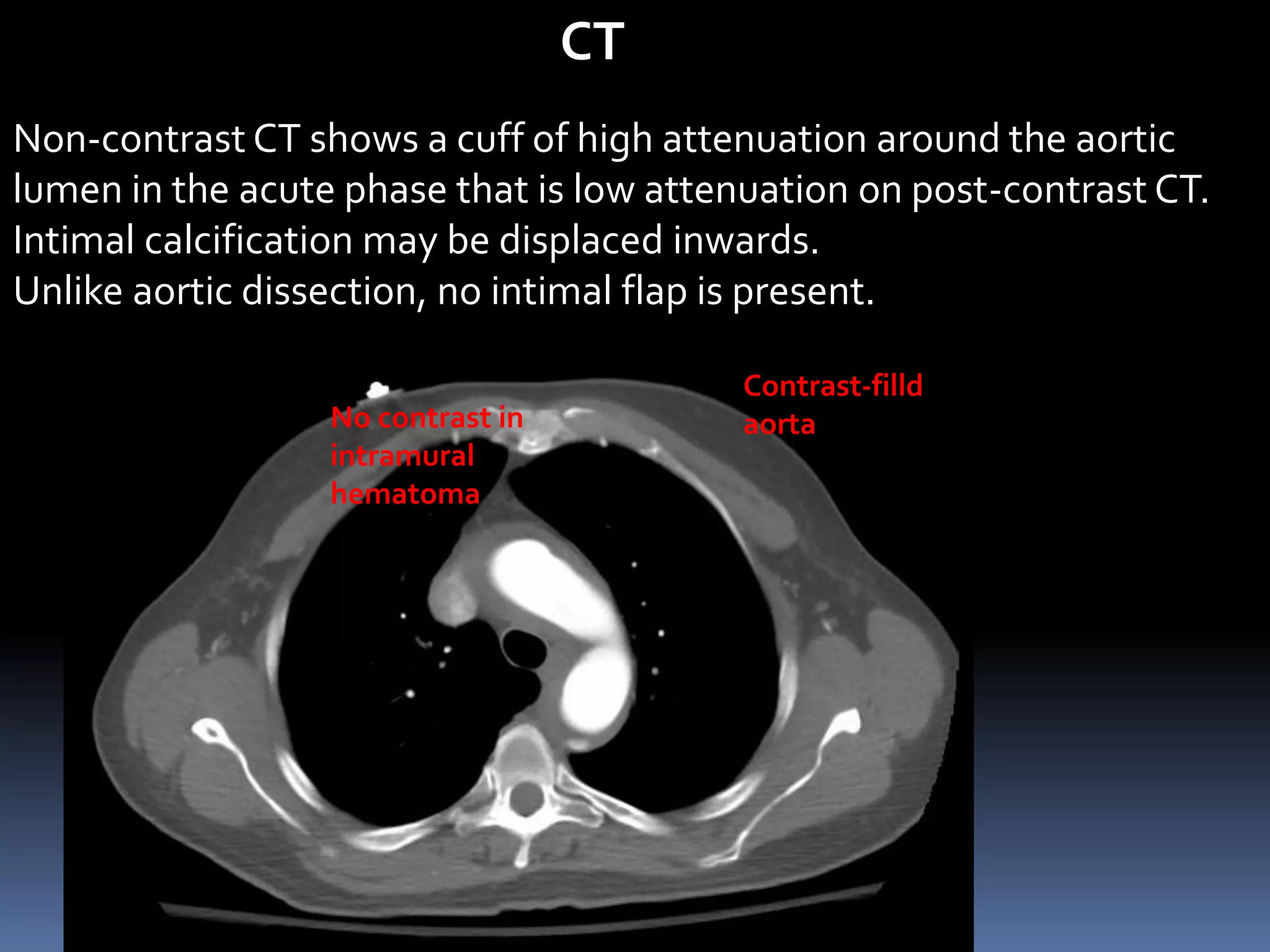 Aortic dissection 01 | PPTX