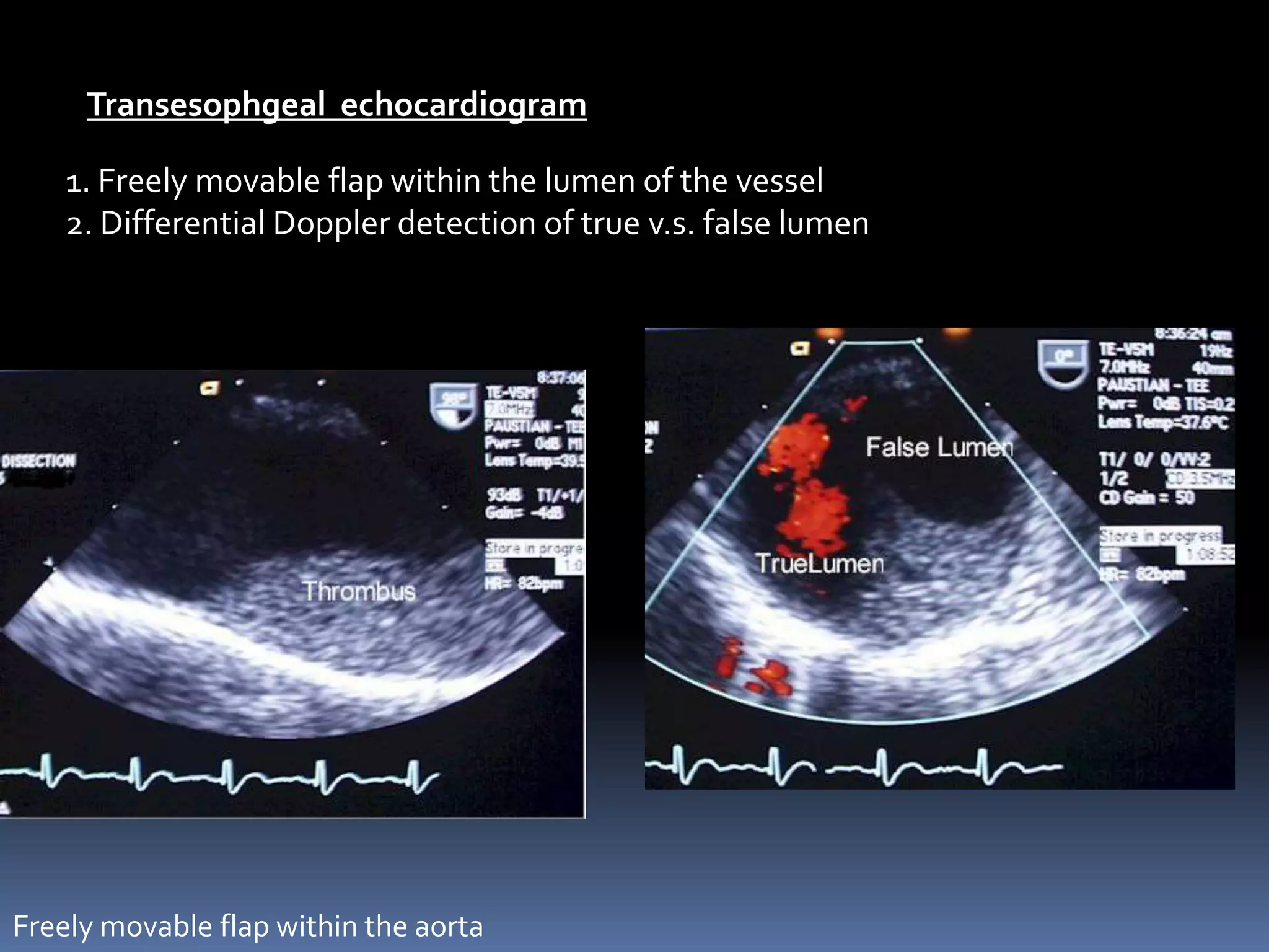 Aortic dissection 01 | PPTX