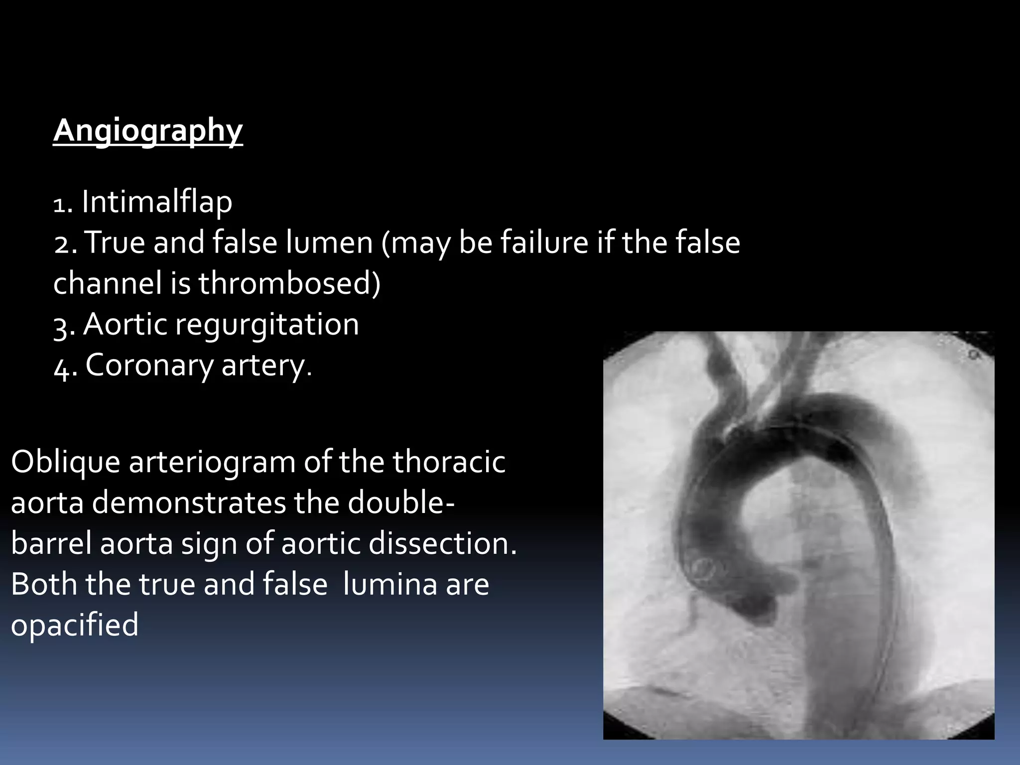 Aortic dissection 01 | PPTX