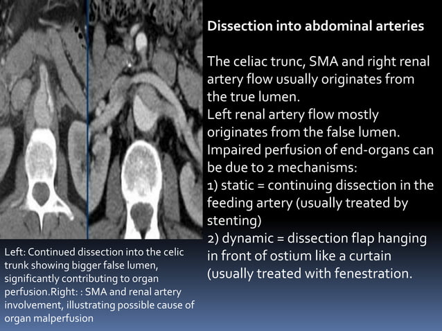 Aortic dissection 01 | PPTX | Heart and Cardiovascular Diseases | Diseases and Conditions