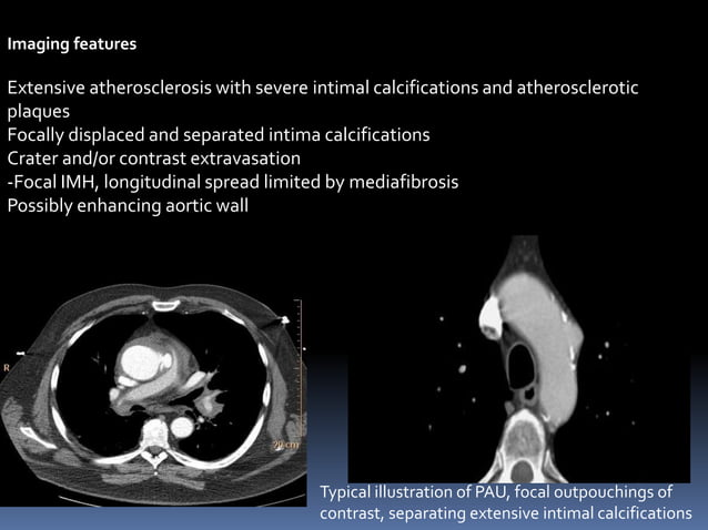 Aortic dissection 01 | PPTX | Heart and Cardiovascular Diseases | Diseases and Conditions