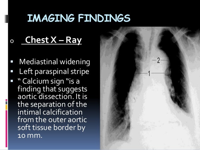 Aortic dissection 01