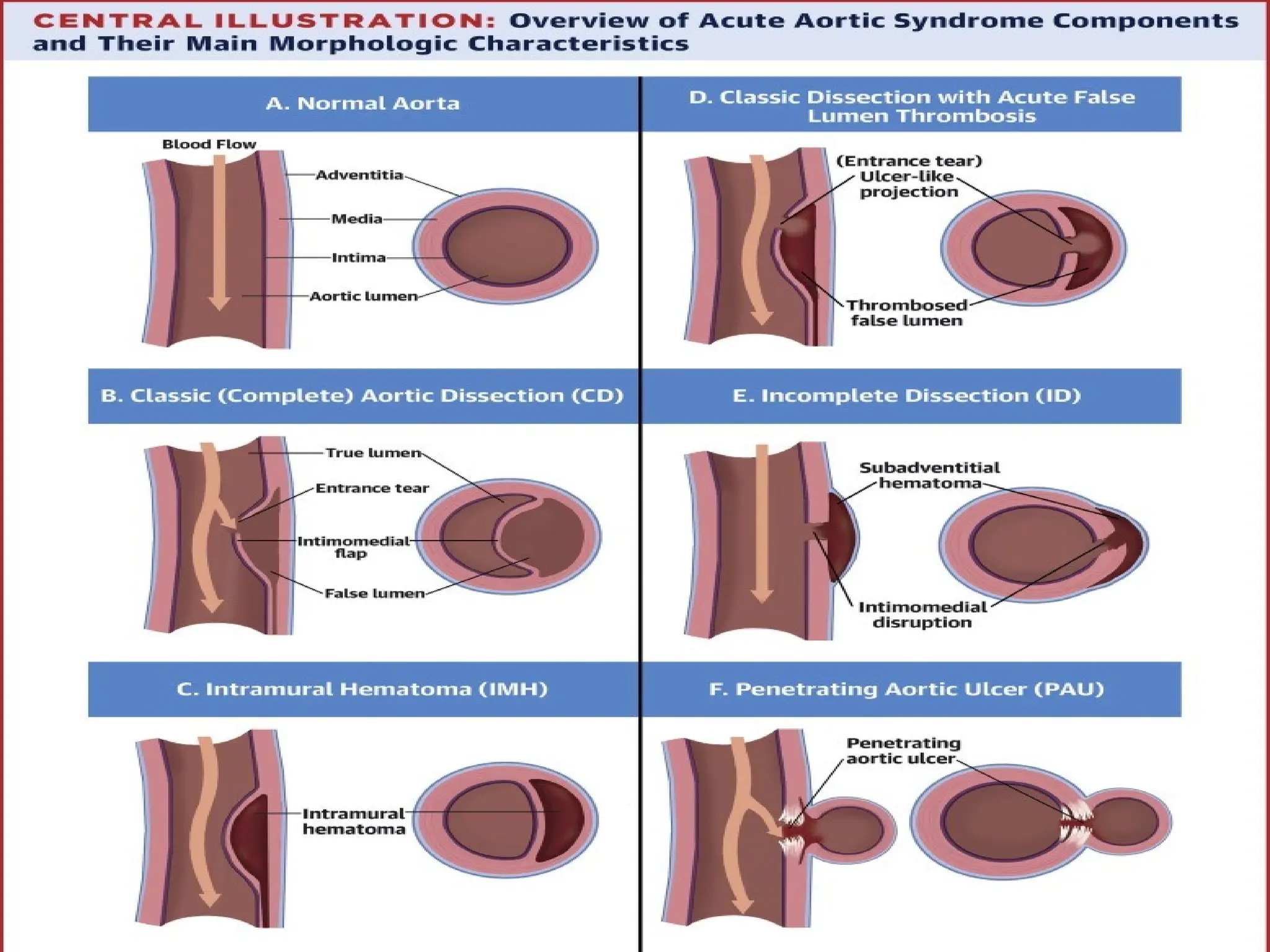Aortic Dissection, Aortic Syndromes & Aneurysmal Diseases by KEYUR.pptx