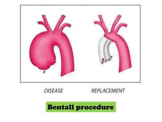 Aortic dissection by bhanu incredible | PPTX