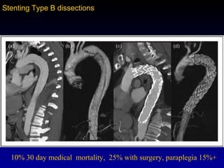 BCC4: Plunkett on Thoracic Aortic Dissection | PPT