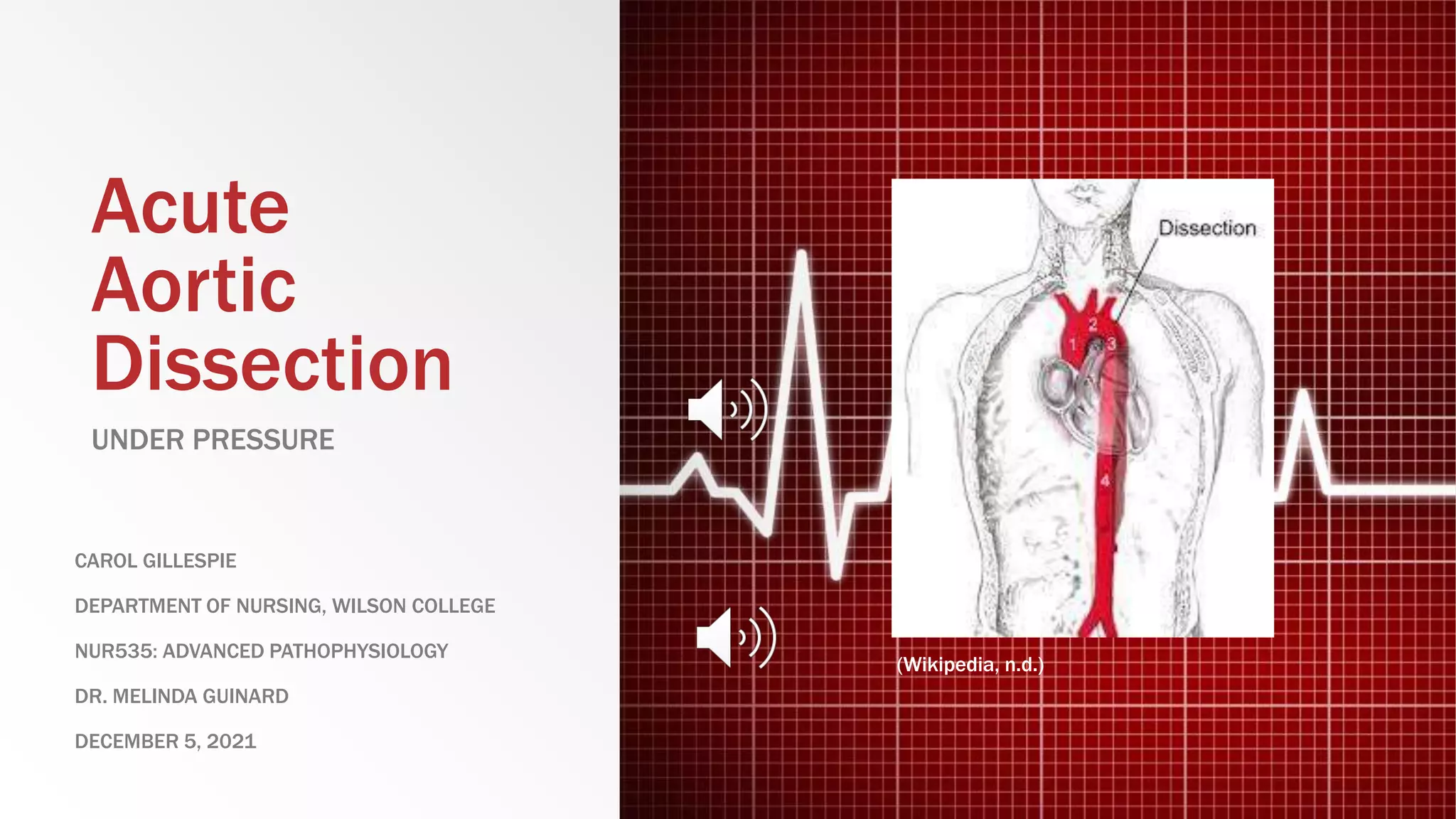 Aortic Dissection_Case Study.pptx