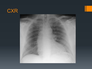 Aortic dissection | PPTX