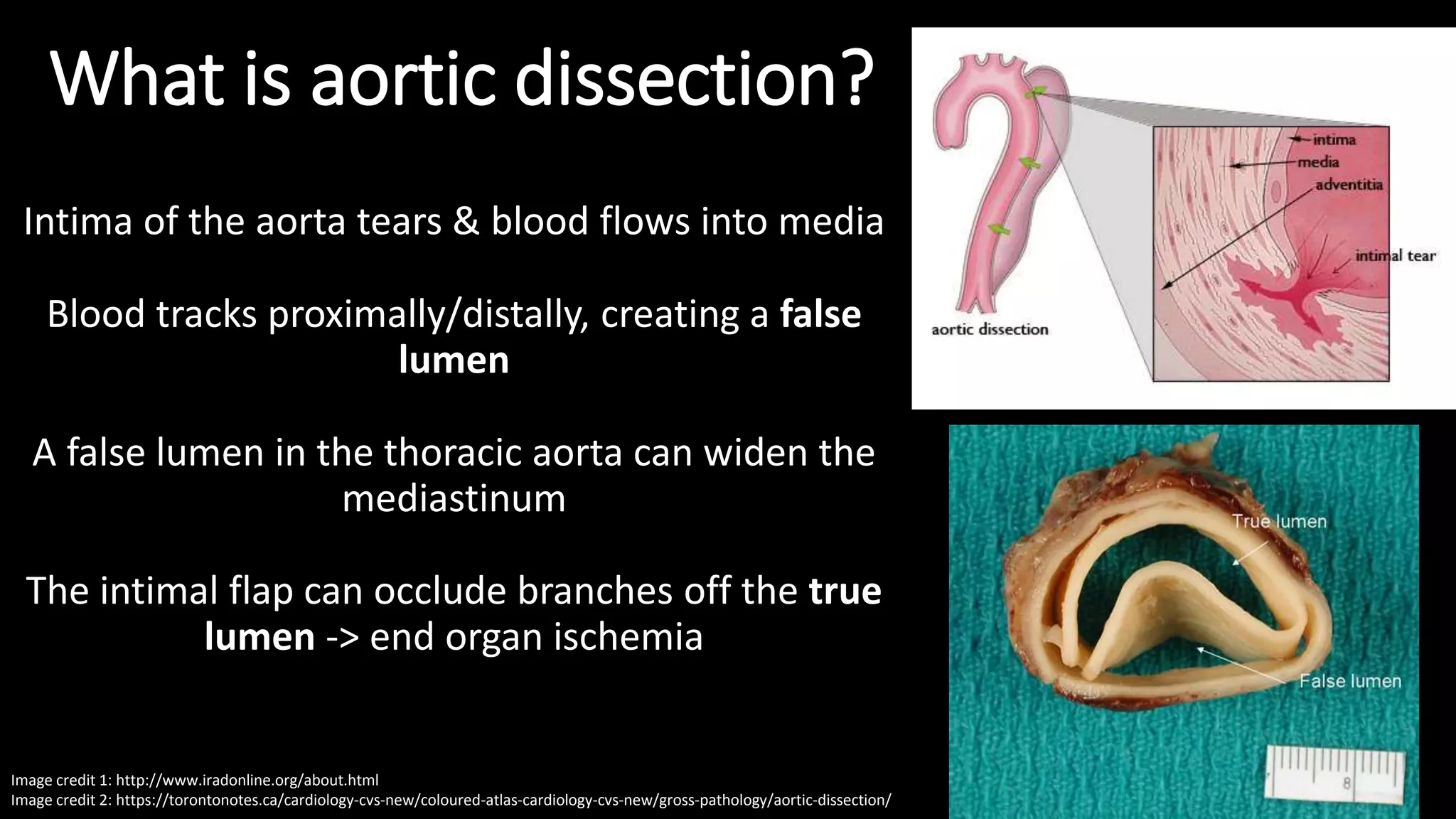 EMGuideWire's Radiology Reading Room: Aortic Dissection | PPTX