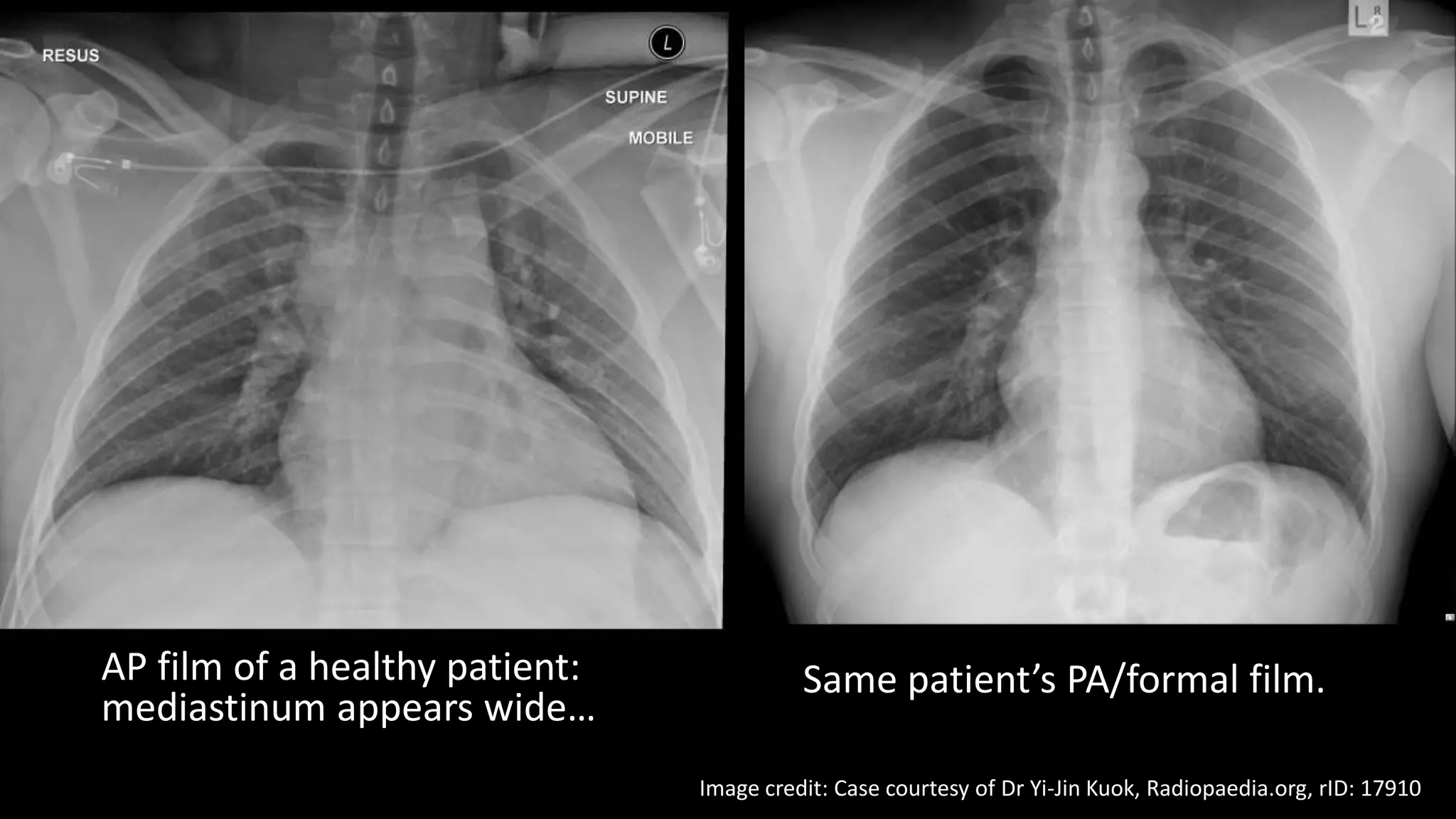 EMGuideWire's Radiology Reading Room: Aortic Dissection | PPTX