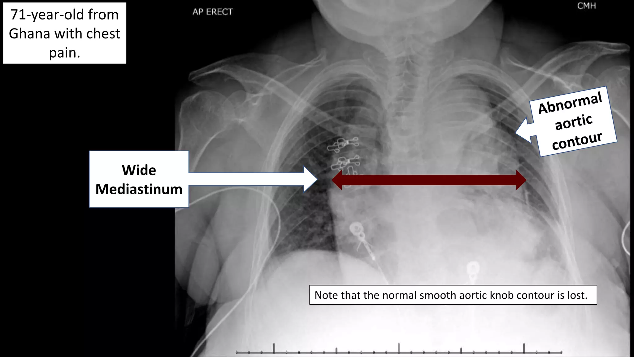 EMGuideWire's Radiology Reading Room: Aortic Dissection | PPTX