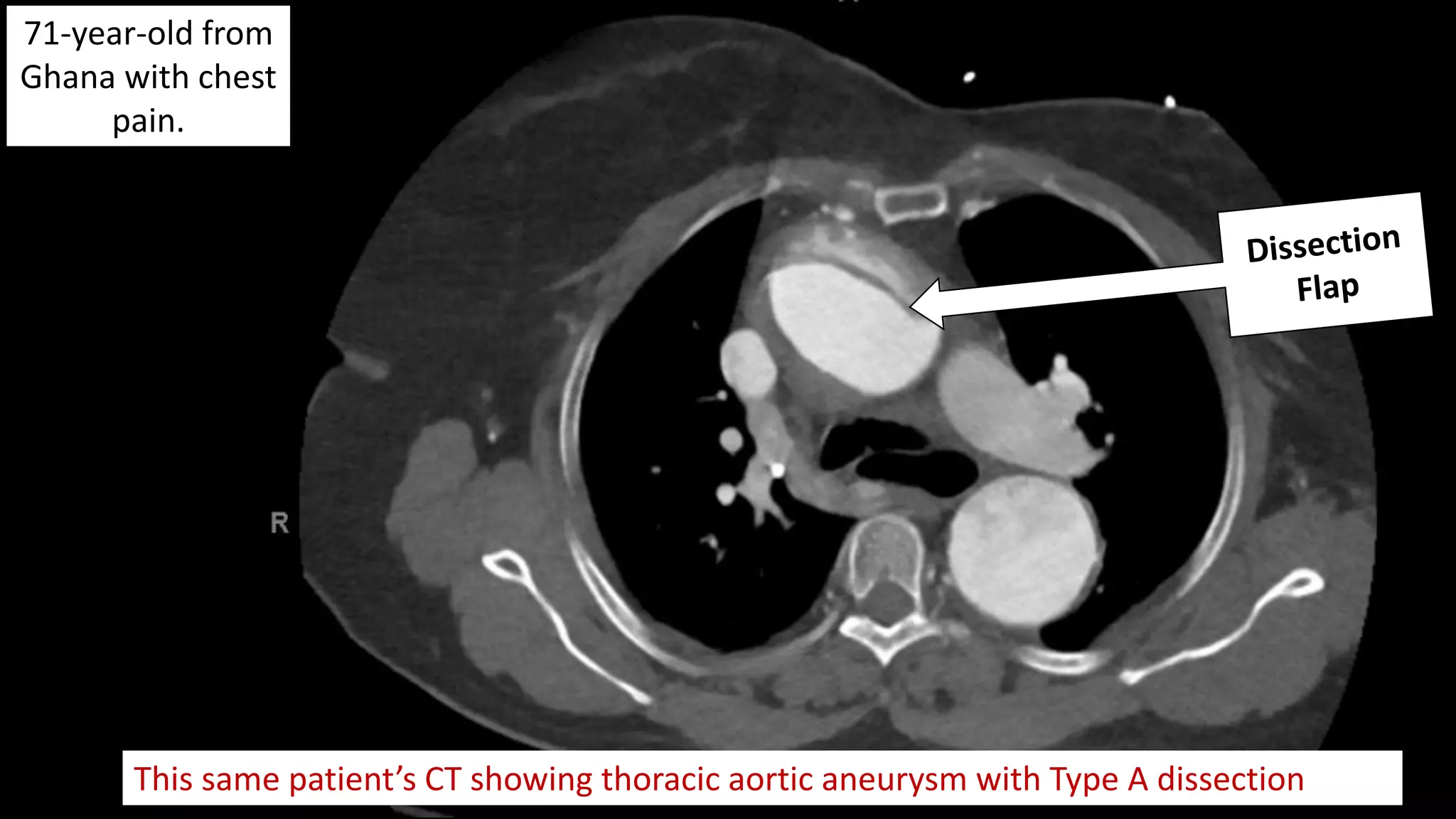 EMGuideWire's Radiology Reading Room: Aortic Dissection | PPTX
