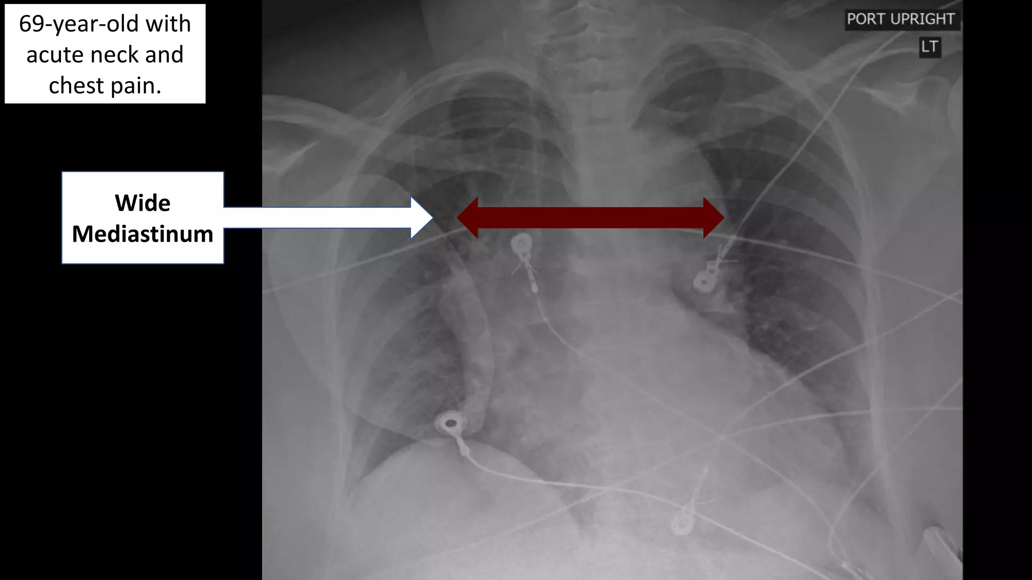 EMGuideWire's Radiology Reading Room: Aortic Dissection | PPTX