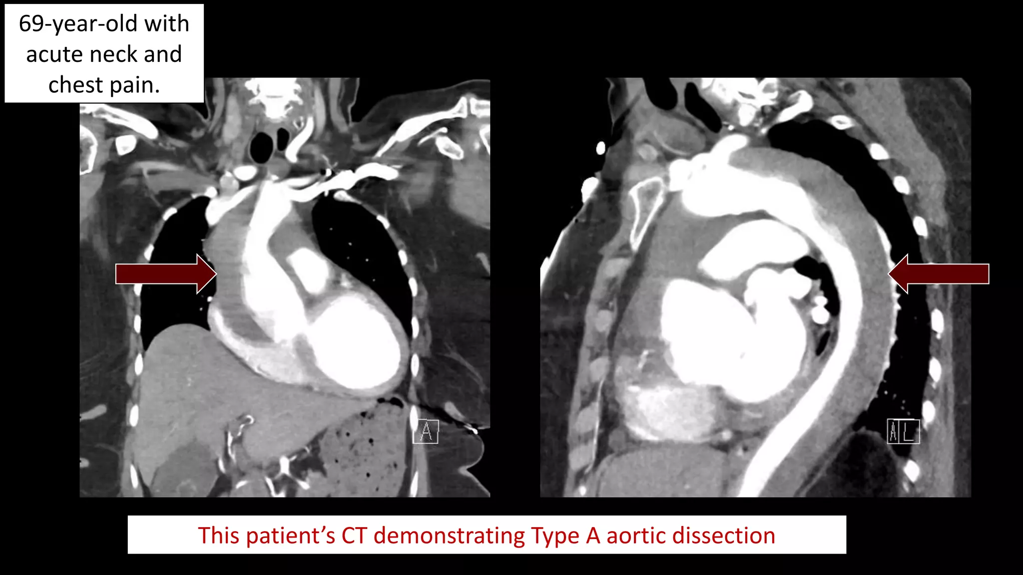 EMGuideWire's Radiology Reading Room: Aortic Dissection | PPTX