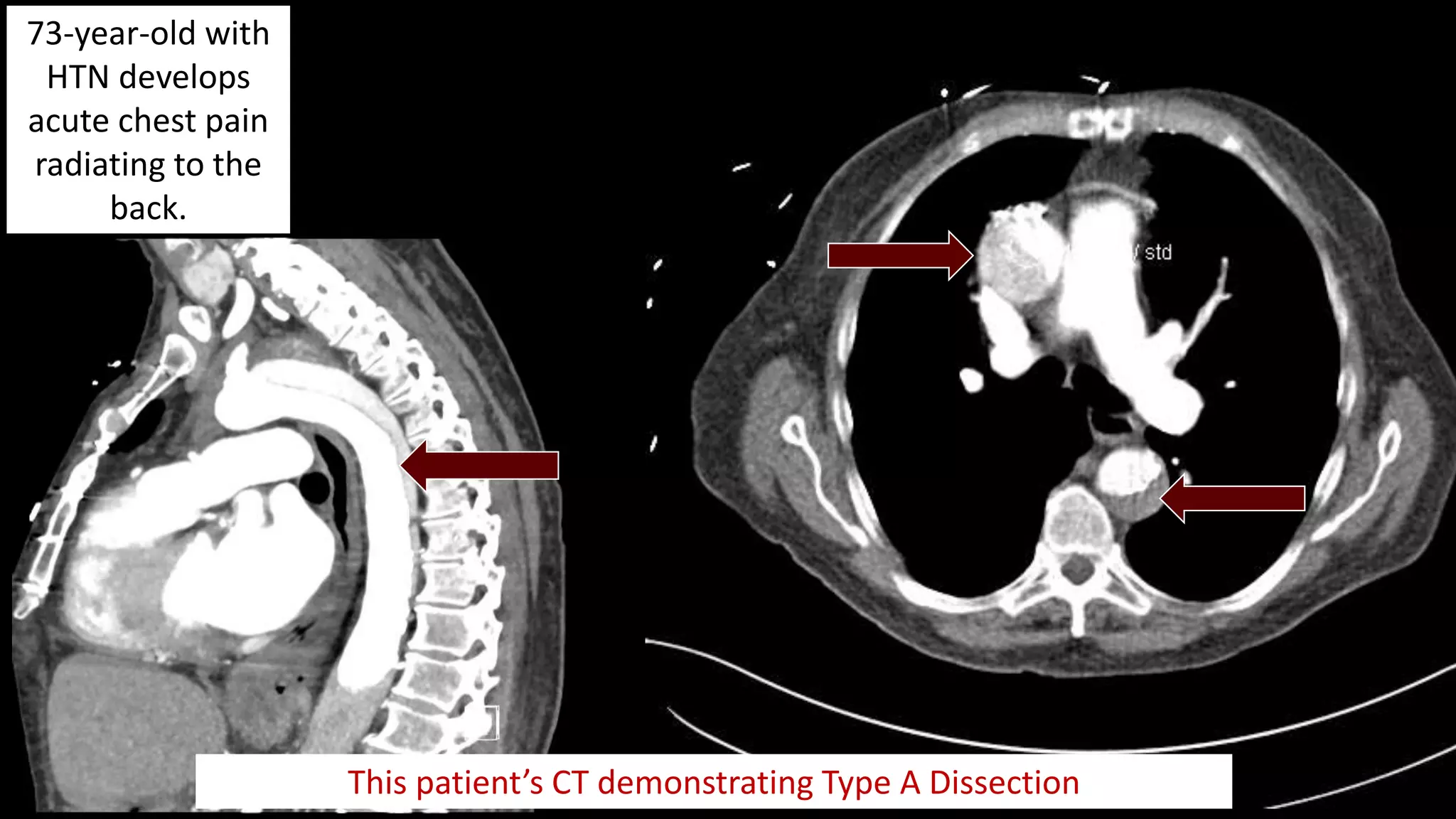 EMGuideWire's Radiology Reading Room: Aortic Dissection | PPTX
