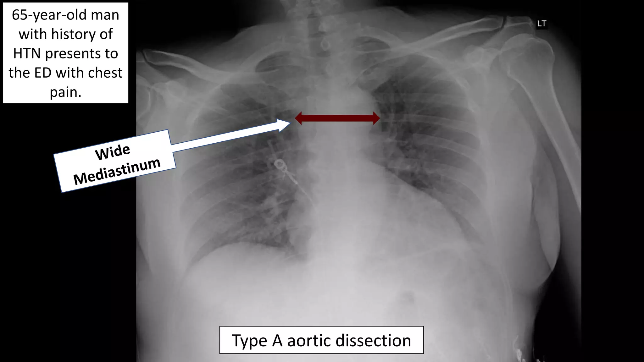 EMGuideWire's Radiology Reading Room: Aortic Dissection | PPTX