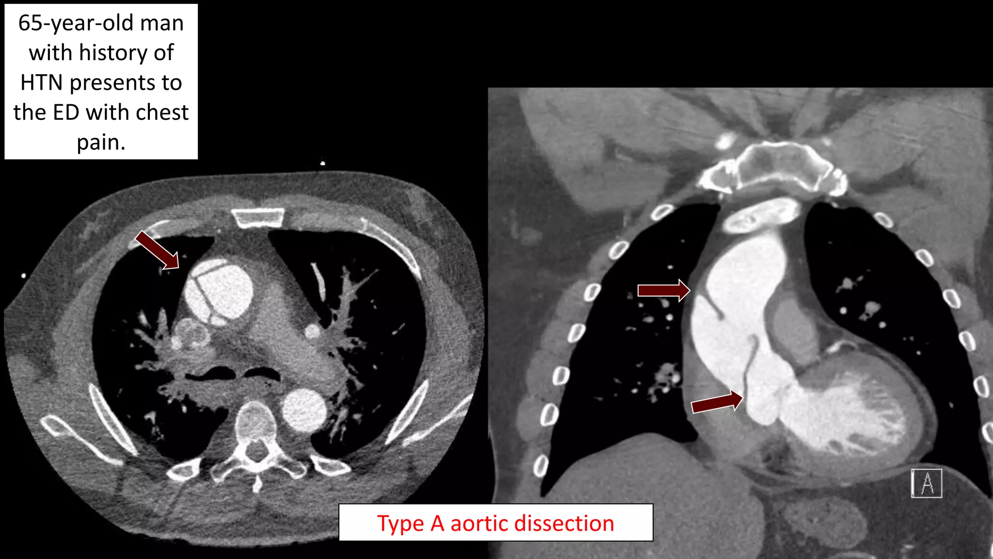 EMGuideWire's Radiology Reading Room: Aortic Dissection | PPTX