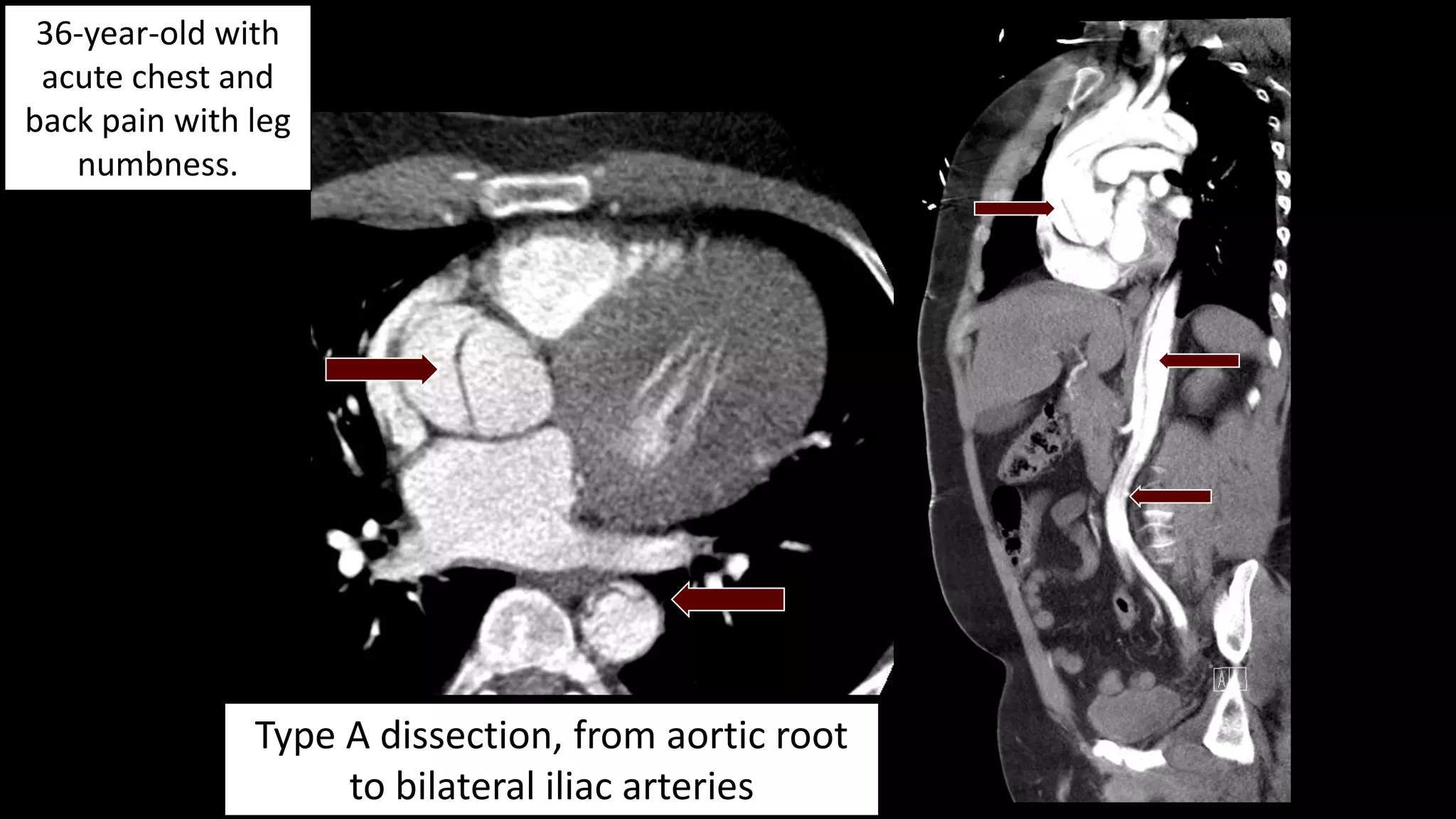 EMGuideWire's Radiology Reading Room: Aortic Dissection | PPTX
