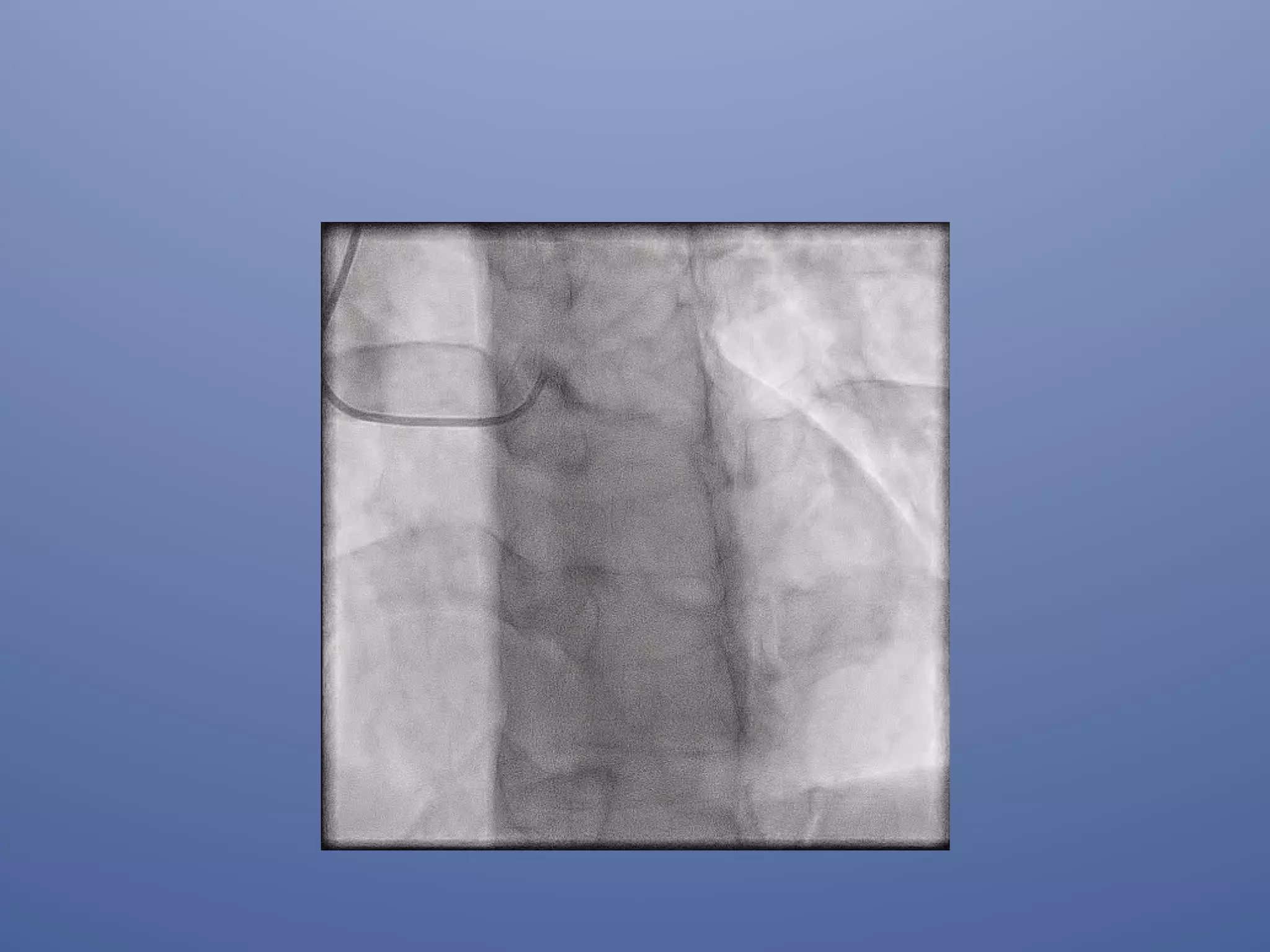 Aortic dissection in PCI.pdf