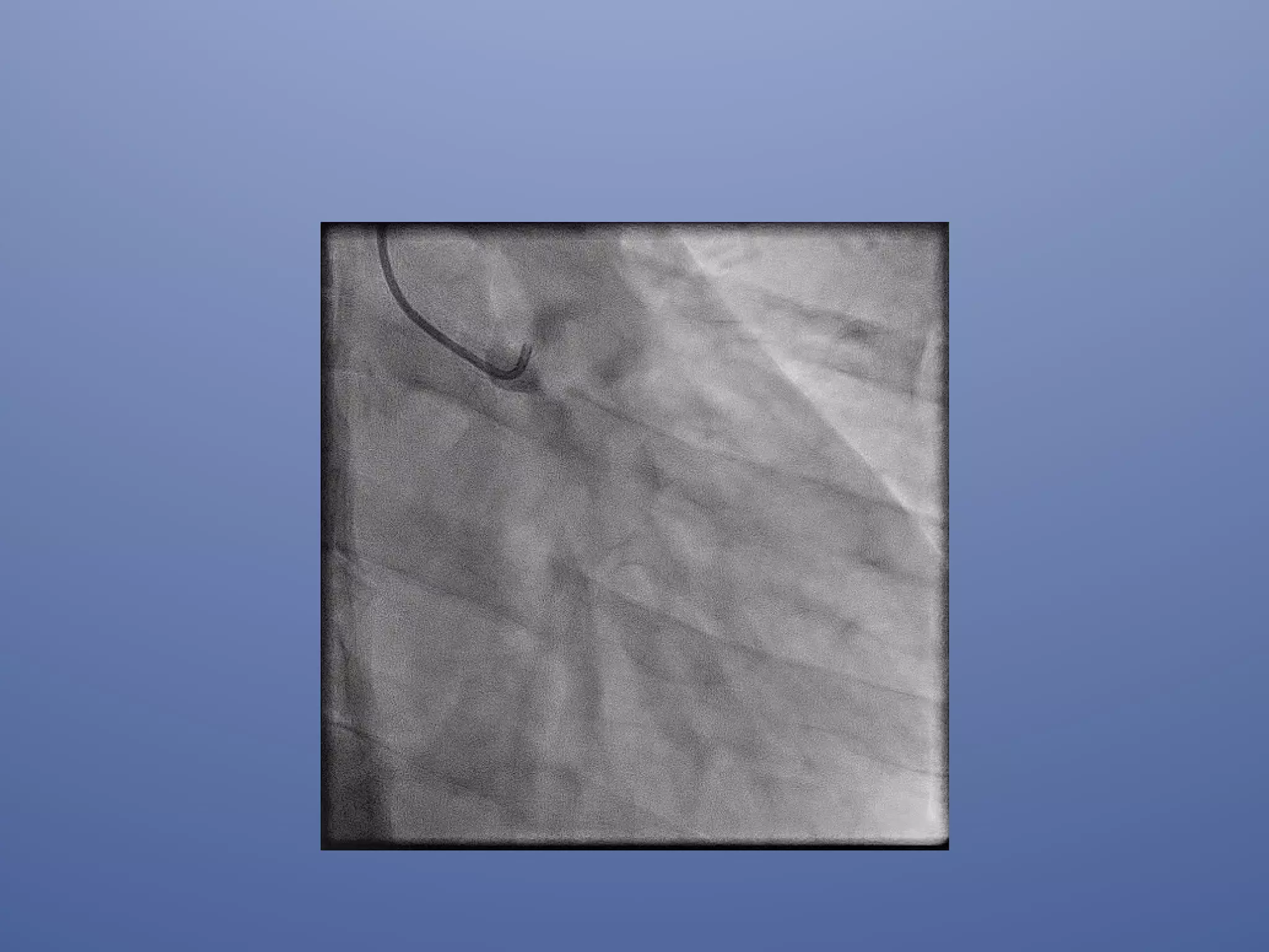 Aortic dissection in PCI.pdf