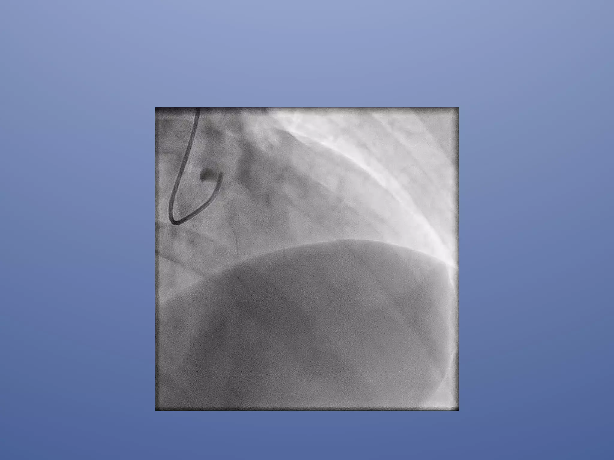 Aortic dissection in PCI.pdf