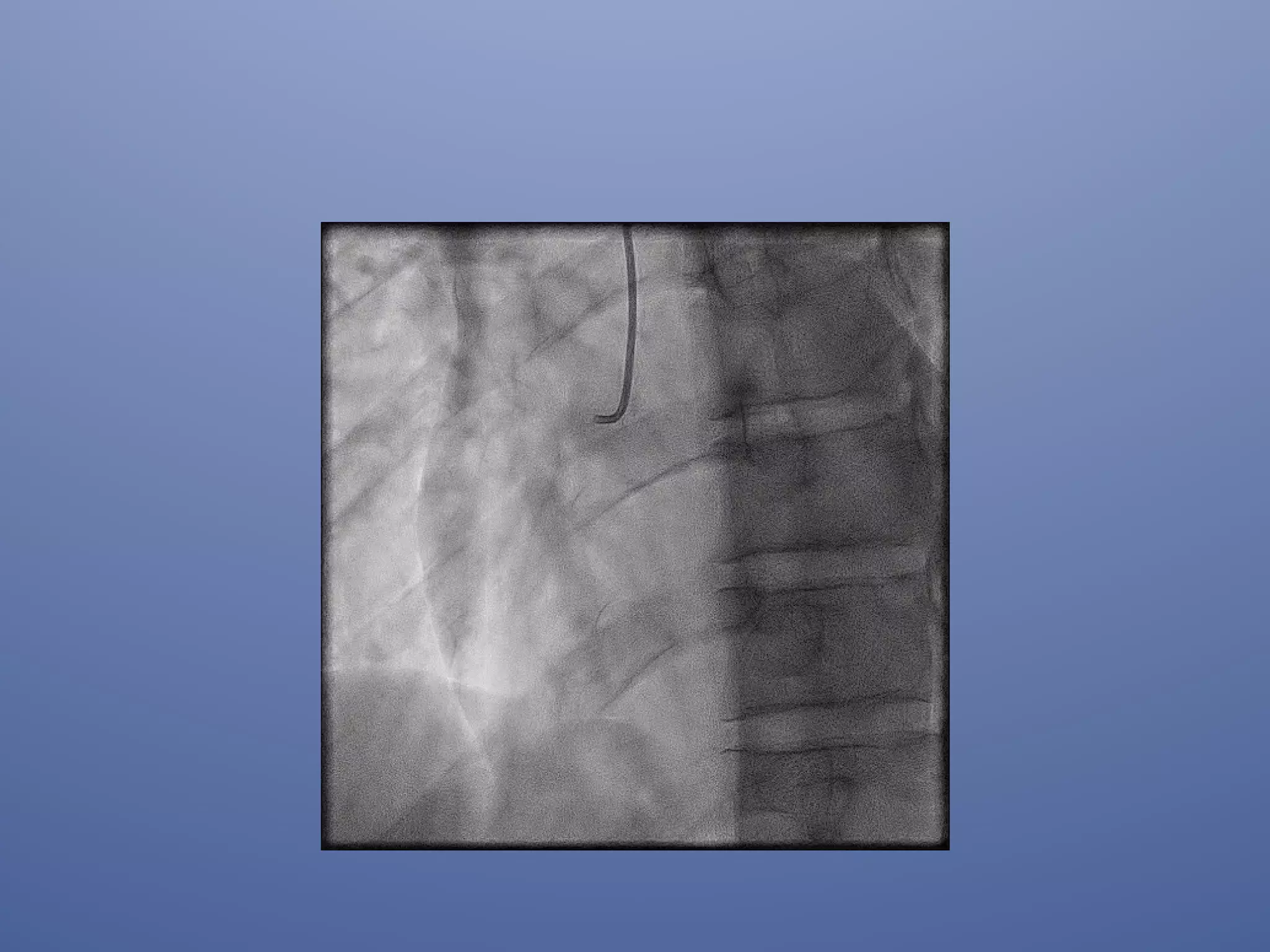Aortic dissection in PCI.pdf