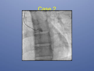 Aortic dissection in PCI.pdf