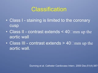 Aortic dissection in PCI.pdf