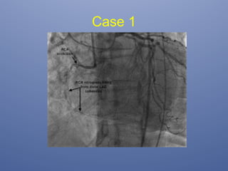 Aortic dissection in PCI.pdf