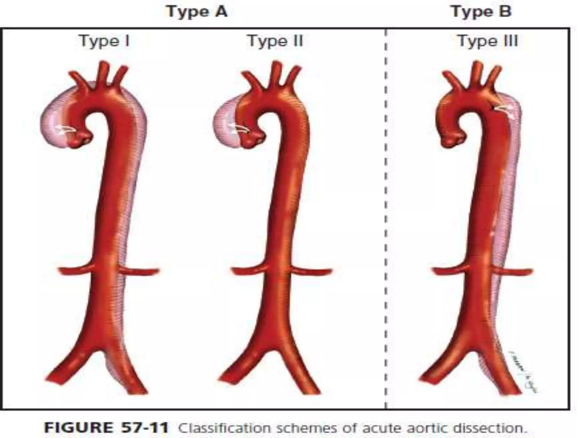 Aortic dissection ppt | PPTX