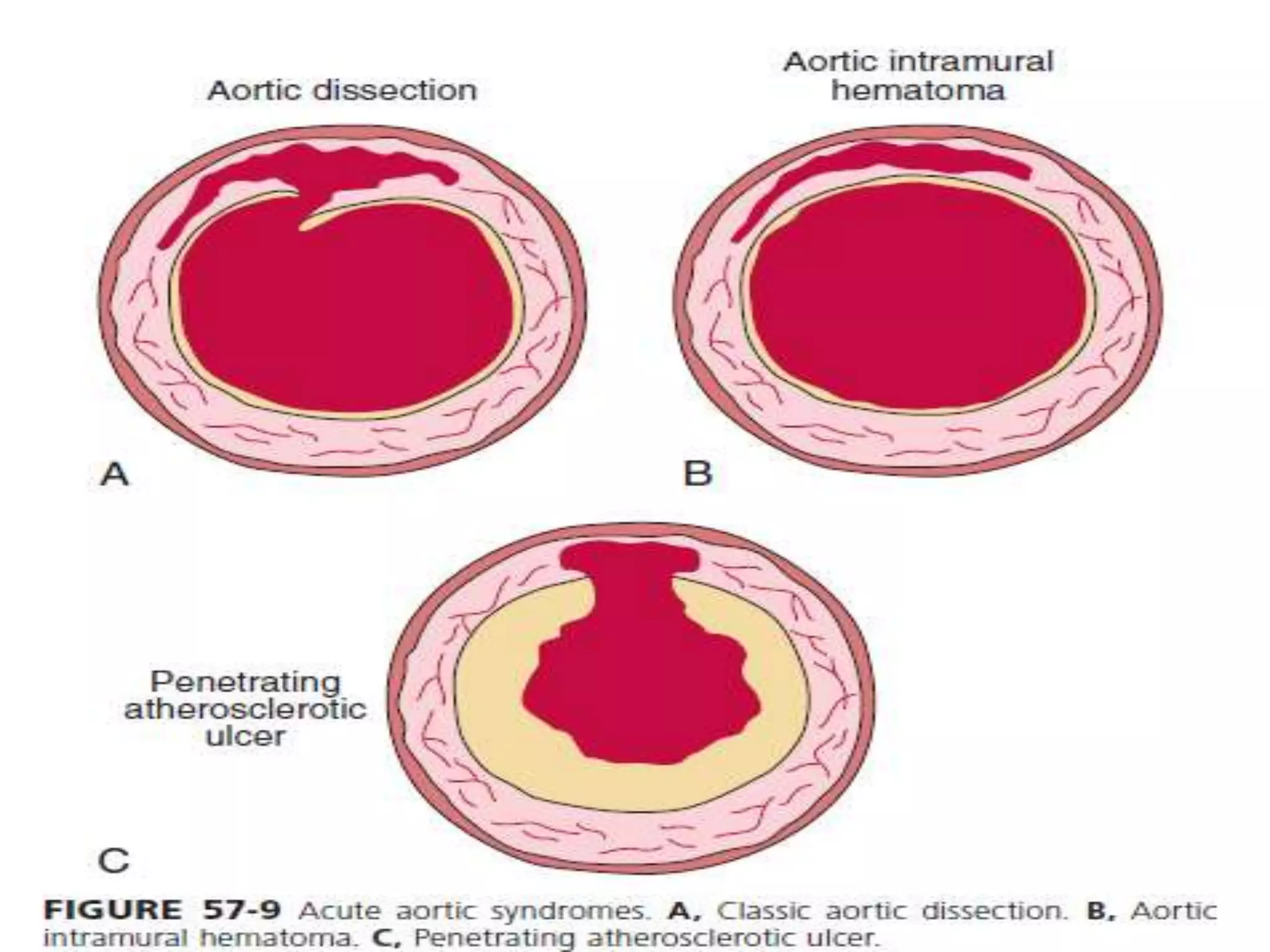 Aortic dissection ppt | PPTX