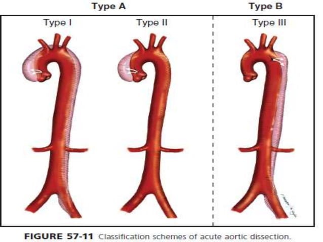 Aortic dissection ppt | PPTX | Heart and Cardiovascular Diseases ...