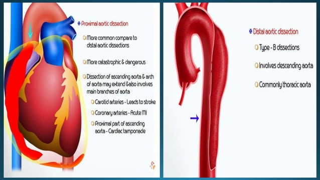 Aortic dissection | PPT