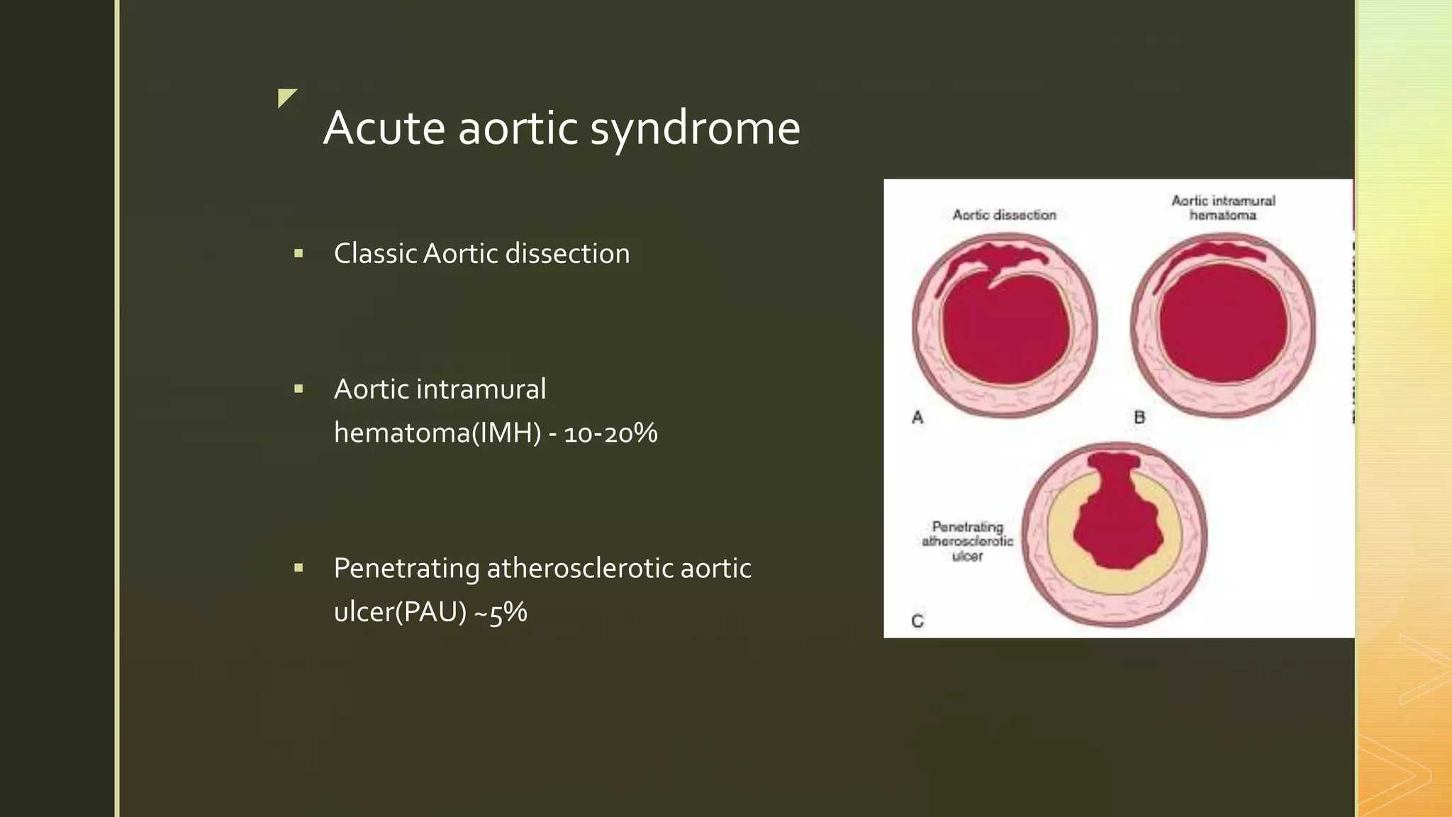 Aortic dissection ppt.pptx
