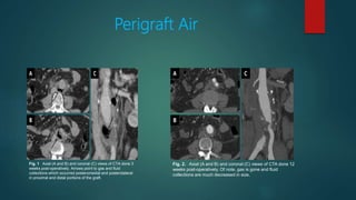Aortic graft infections 2016-University of Arizona | PPTX