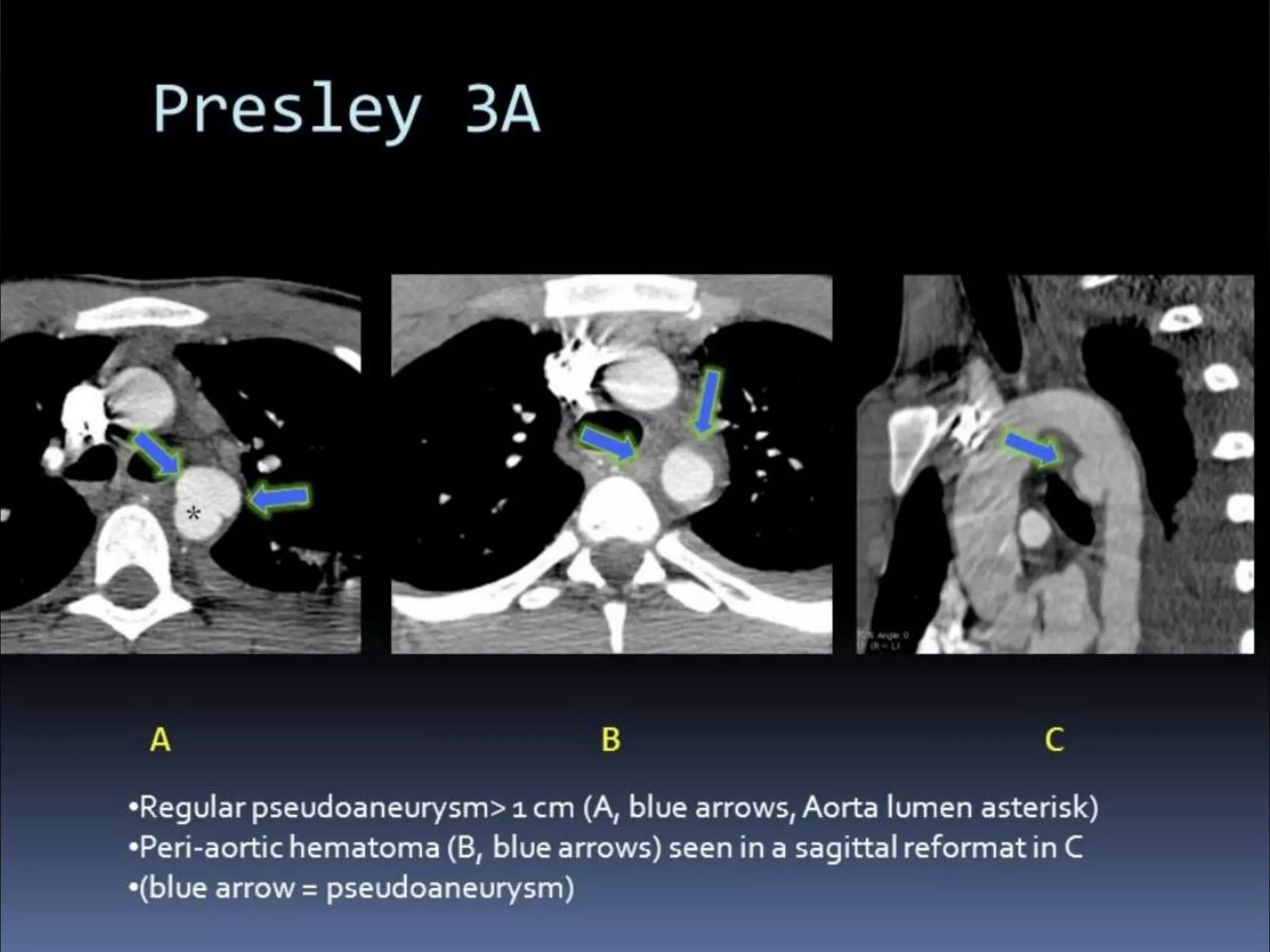 AORTIC INJURY.pptx