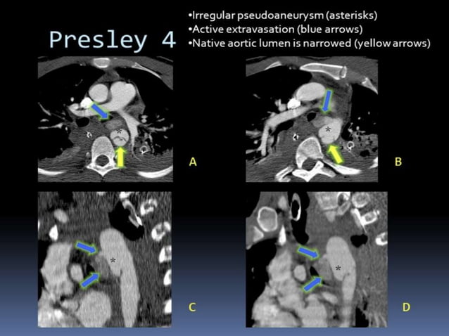 AORTIC INJURY.pptx