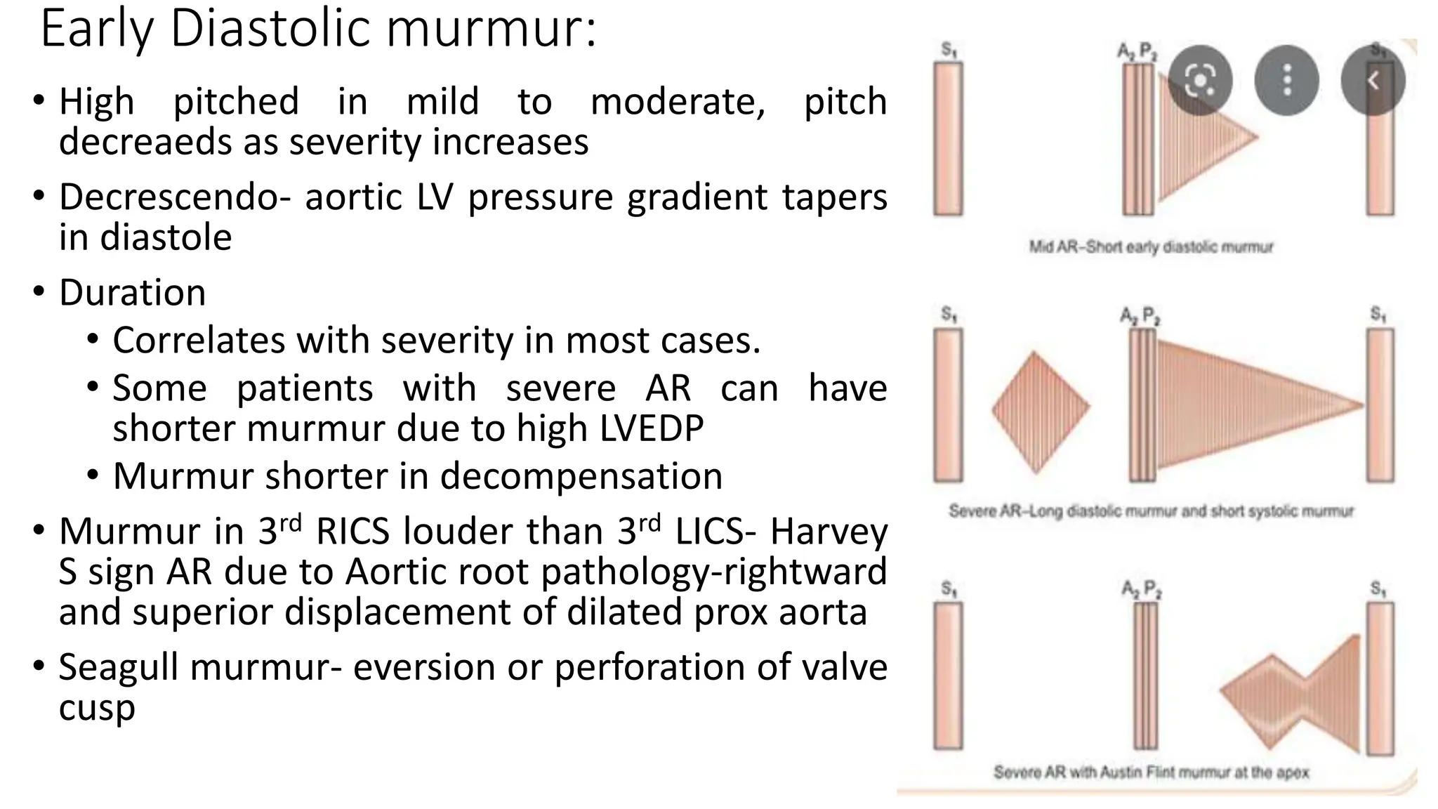valvular heart diseaseAORTIC REGURGITATION.pptx