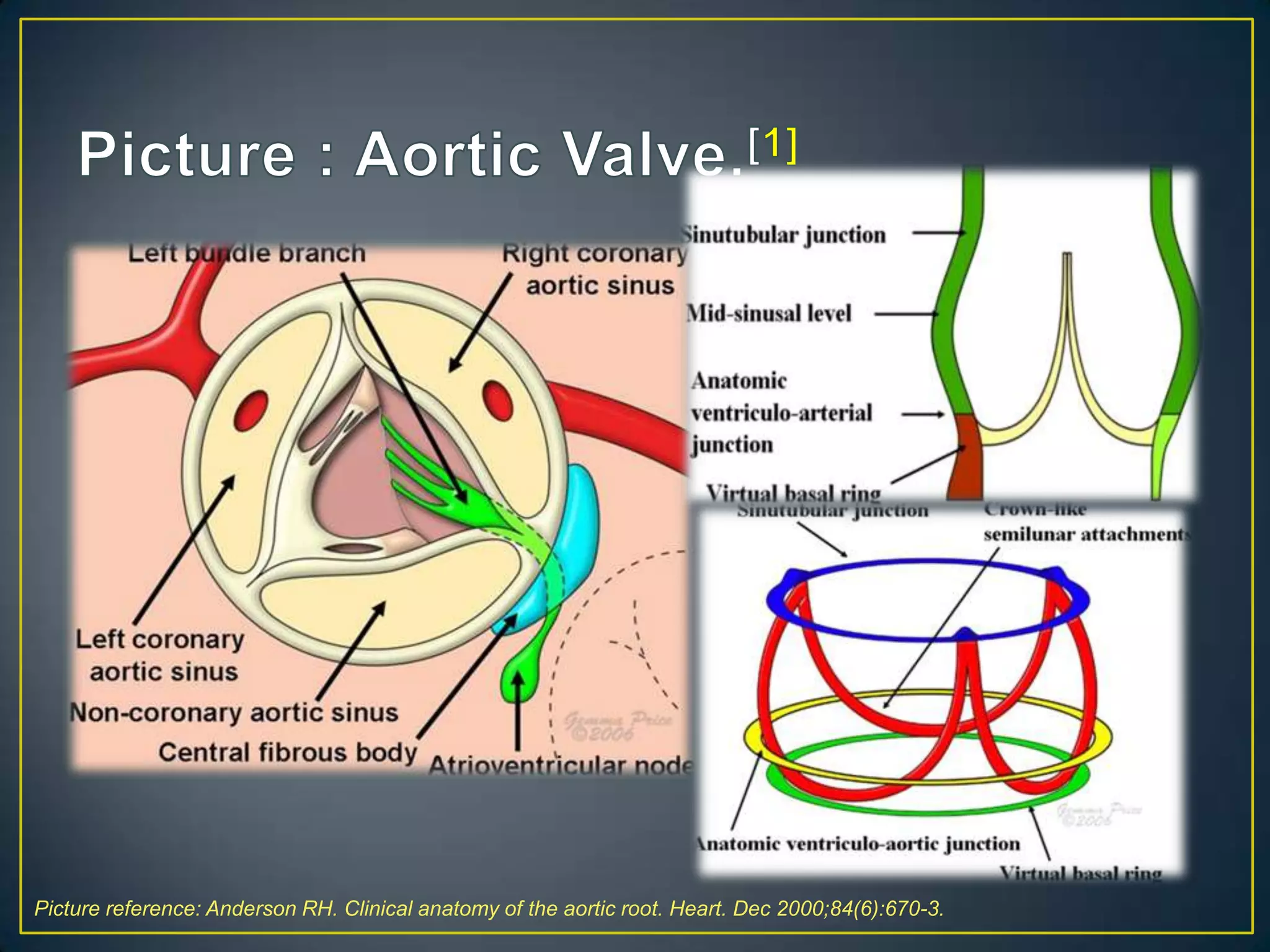 Aortic regurgitation | PPTX